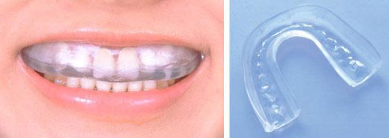 ฟันยาง－บล็อก คลินิคทันตกรรมโยซึบะ